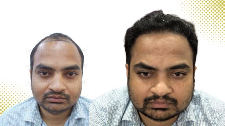 Best Hair Transplant Clinic In Ahmedabad Hair Transplant